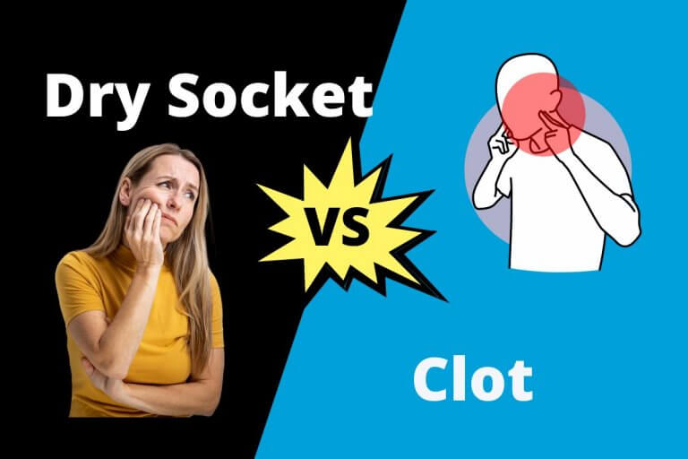 Dry Socket Vs Clot: What's The Difference? | ContrastHub